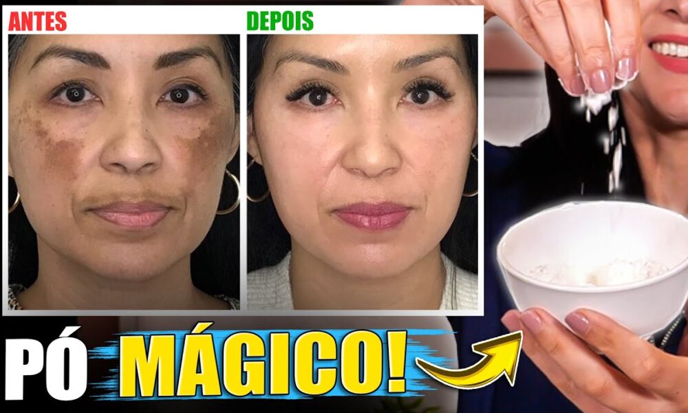 Use esse PÓ para Clarear Manchas de Pele, inclusive Melasma - Programa e Dietas